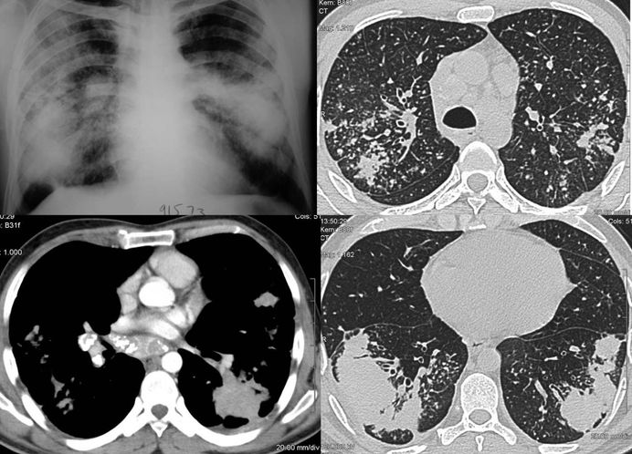 Silicosis - CT Chest Review