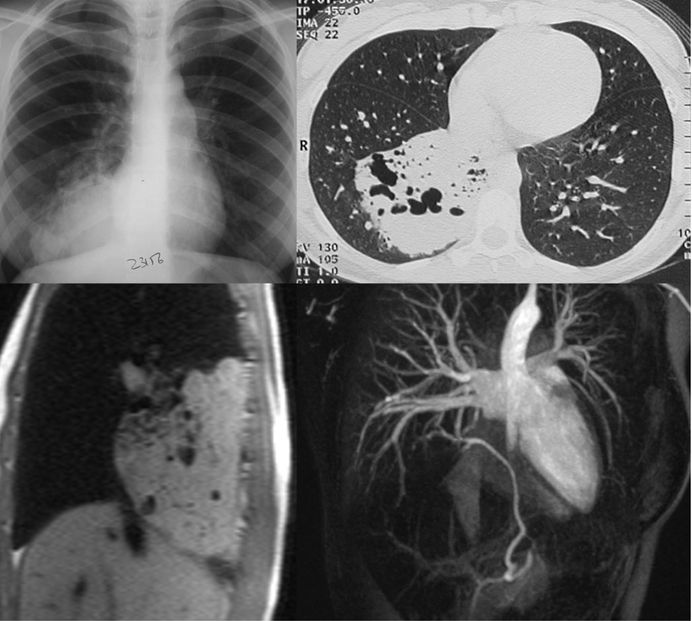 Lung Mass - CT Chest Review
