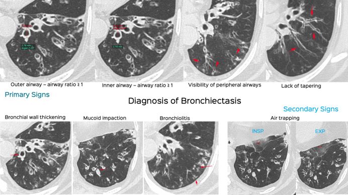 Bronchiectasis - CT Chest Review