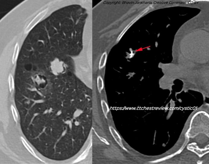 Cystic Lung Disease - CT Chest Review