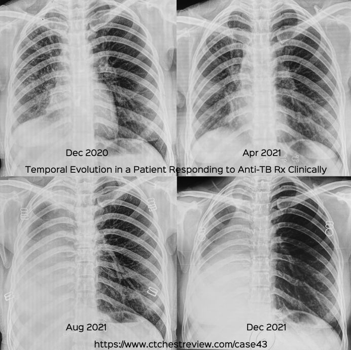 Tuberculosis - CT Chest Review