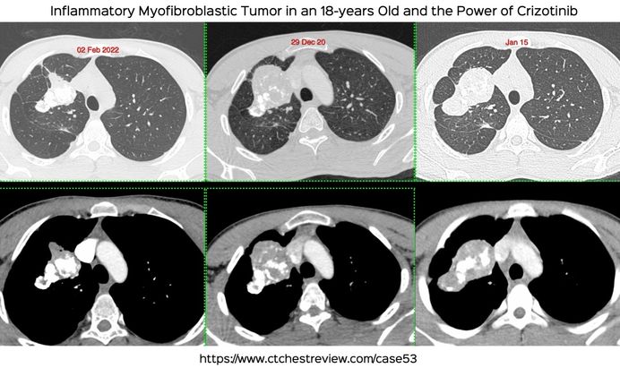 Lung Mass - CT Chest Review