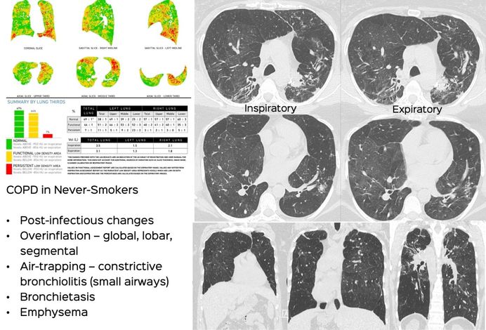 Snippet 12: Visual Classification of Centrilobular and Paraseptal Emphysema