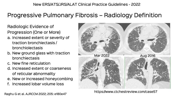 Case 57: Progressive Pulmonary Fibrosis – The 2022 ATS/ERS/JRS/ALAT ...
