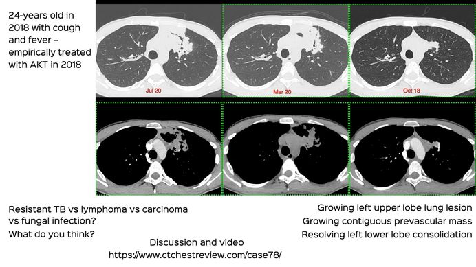 COD 141 - Cartilage in the Lung