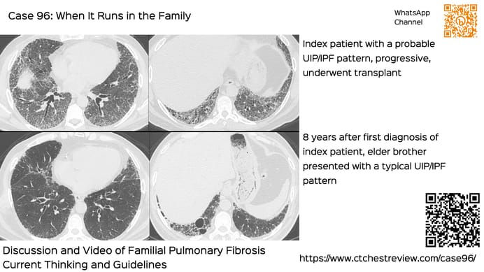 Usual Interstitial Pneumonia (UIP) Idiopathic Pulmonary Fibrosis (IPF)