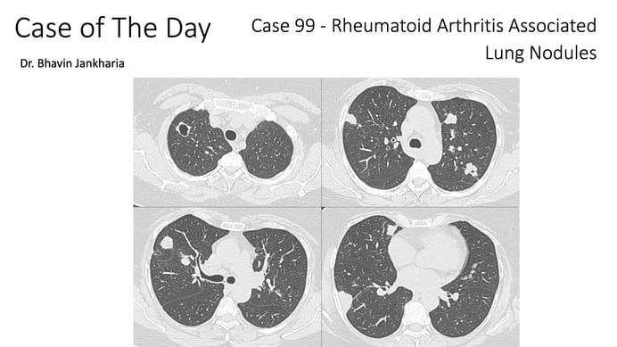 Case of the Day - 099 - Rheumatoid Arthritis Associated Lung Nodules