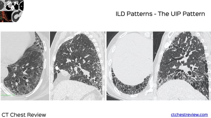 Case 91: Bubble Lucencies, Central Lucencies, Bubbly Consolidation